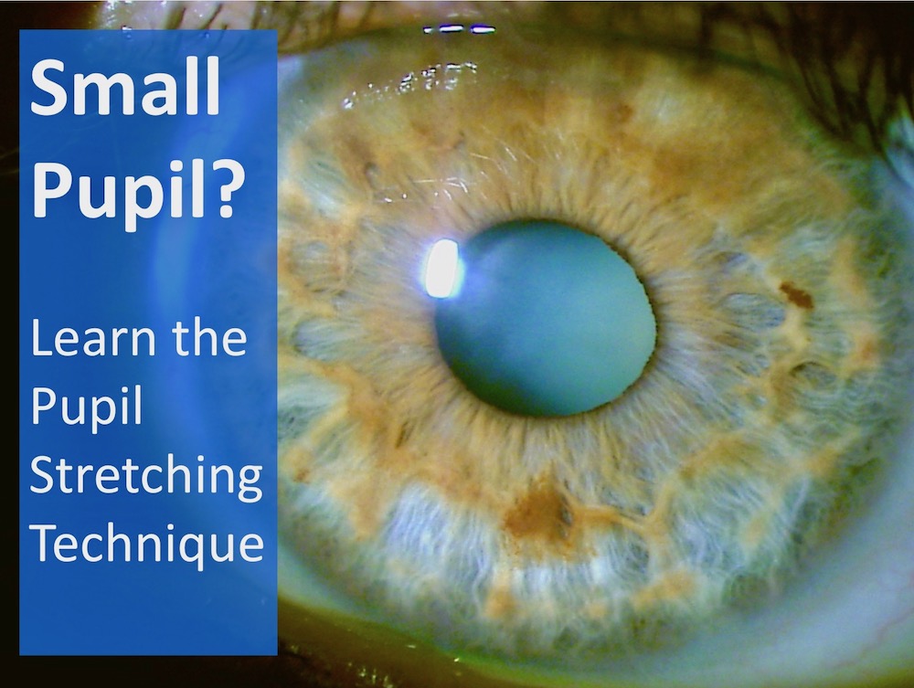 Cataract Surgery with Pupil Stretching – Cataract Coach