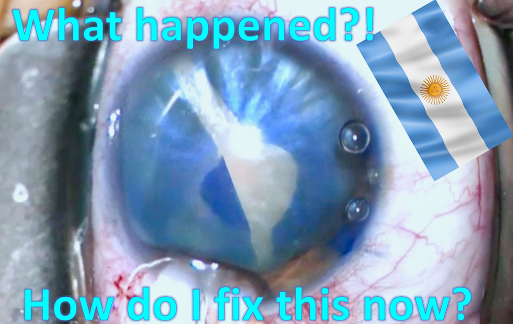 White Cataract: Run-Away Capsulorhexis. Help! – Cataract Coach
