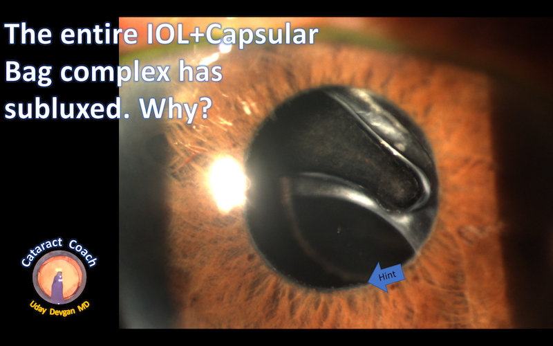 3 Keys to doing 4-point Sceral-sutured IOLs – Cataract Coach