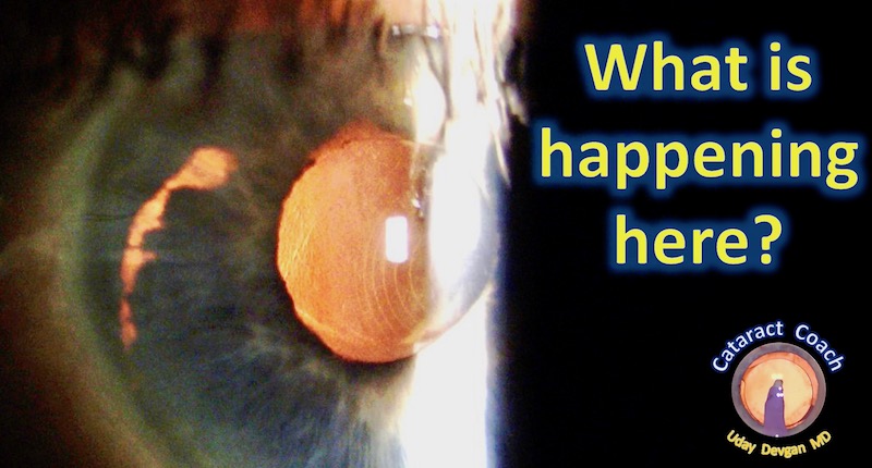 Why did this IOL de-center? – Cataract Coach