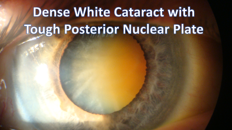 White Cataract: Solution for the Dense Posterior Nuclear Plate ...