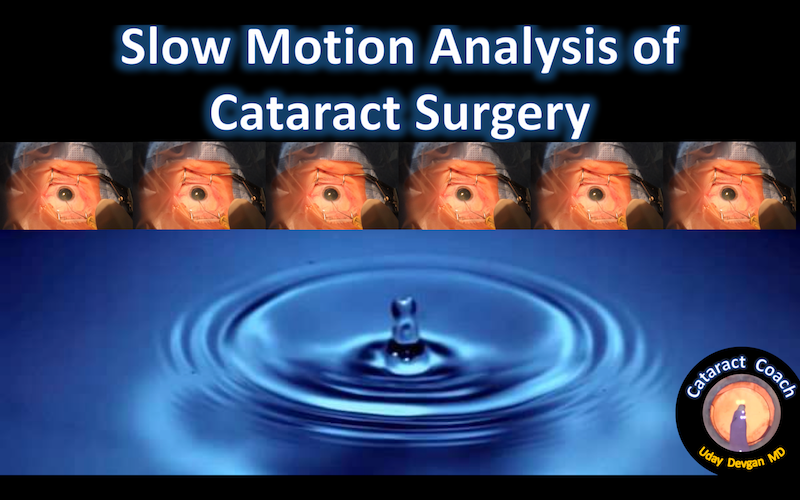 Slow Motion Analysis of Cataract Surgery – Cataract Coach