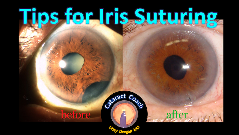 4 Crucial Tips for Iris Suturing – Cataract Coach
