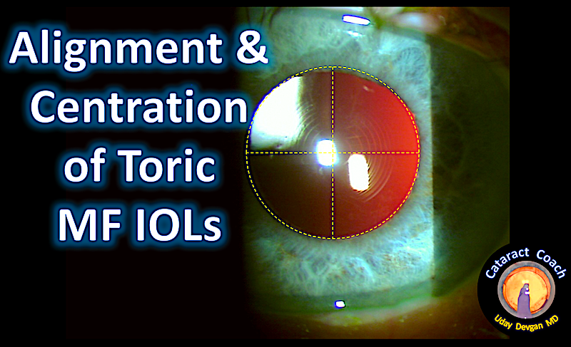 Alignment and Centration of Toric Multi-Focal IOLs – Cataract Coach
