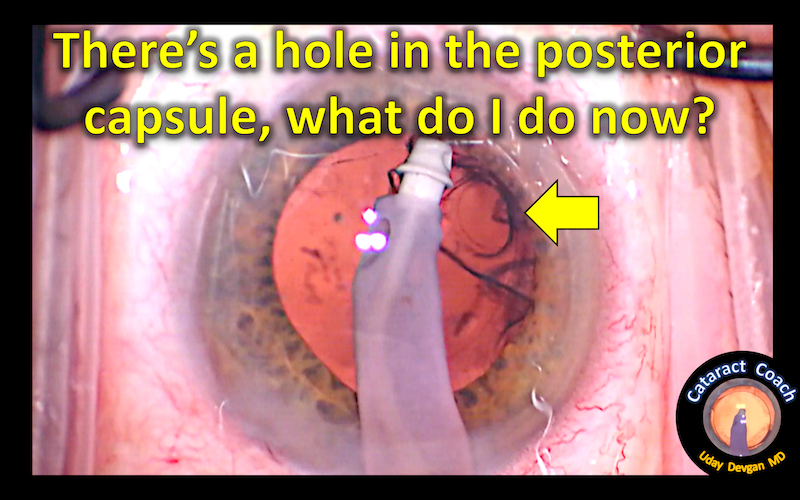 Recovering from a Hole in the Posterior Capsule – Cataract Coach