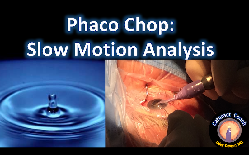 Slow Motion Analysis of Phaco Chop – Cataract Coach