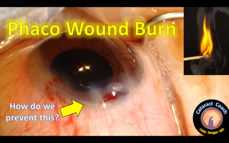 Why did we get a Phaco Wound Burn? – Cataract Coach