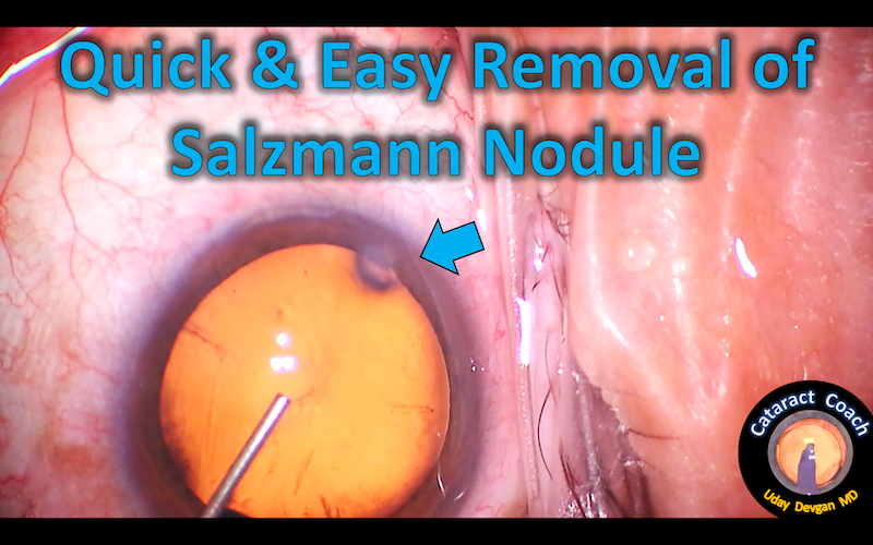 Salzmann Nodules and Cataract Surgery – Cataract Coach