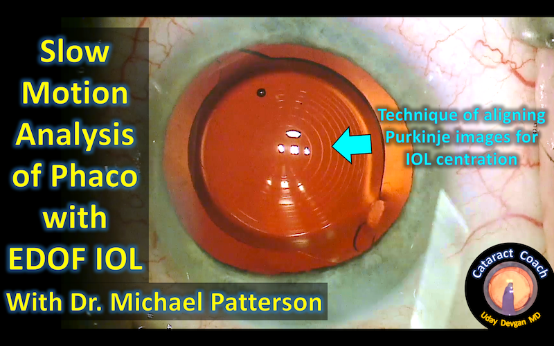 Slow Motion Analysis of Phaco with EDOF IOL – Cataract Coach™