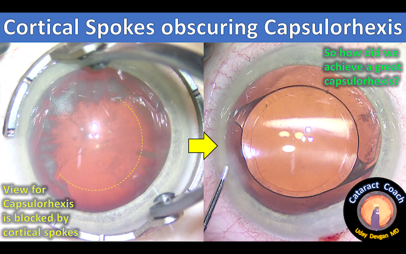 Cortical Spokes blocking the view for Capsulorhexis – Cataract Coach