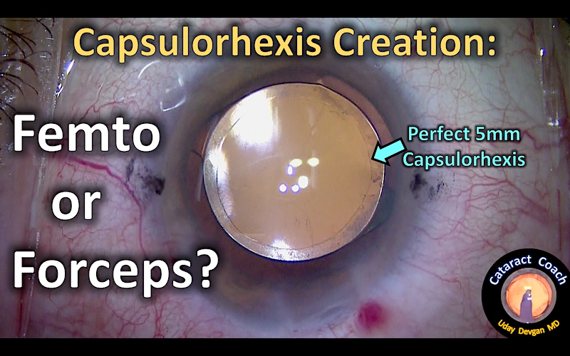 For the Capsulorhexis: Femto or Forceps? – Cataract Coach