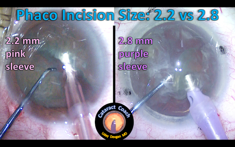 Phaco Incision Size: is smaller always better? – Cataract Coach