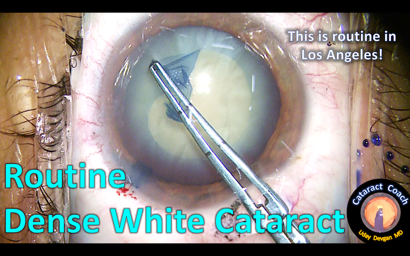 Routine Dense White Cataract Surgery – Cataract Coach