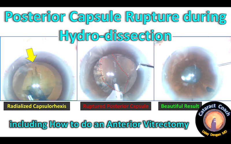 Posterior Capsule Rupture & Anterior Vitrectomy – Cataract Coach