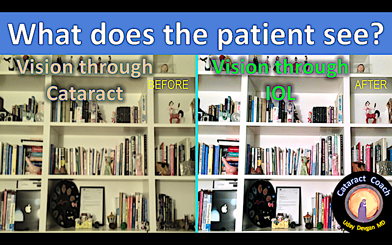 What does the patient actually see? – Cataract Coach