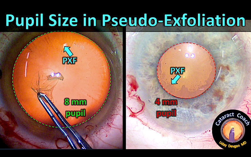 Pupil Size in Pseudo-Exfoliation Cataract Surgery – Cataract Coach