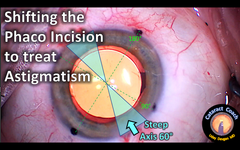 Shifting the Phaco Incision to treat Astigmatism – Cataract Coach