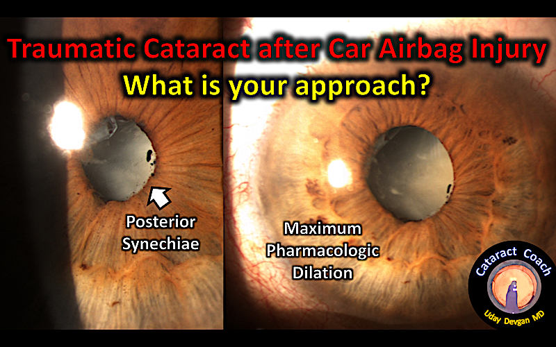 Traumatic Cataract: What is your surgical approach? – Cataract Coach