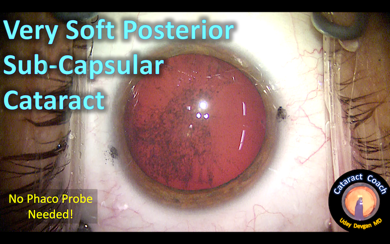 I/A Only Technique for a Very Soft Cataract – Cataract Coach™