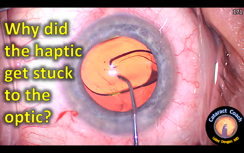 Why did the IOL Haptic get stuck to the Optic? – Cataract Coach