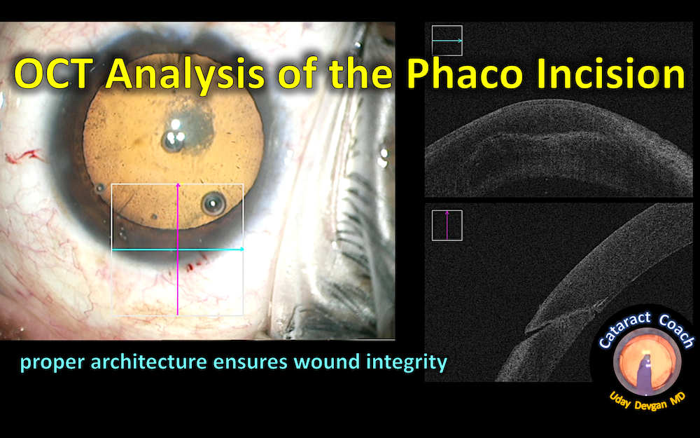 OCT analysis of a corneal phaco incision – Cataract Coach