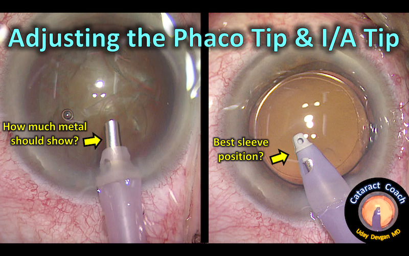 Adjusting the sleeve of the Phaco and I/A tip – Cataract Coach
