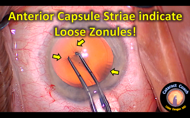 Loose Zonules become evident during Capsulorhexis – Cataract Coach