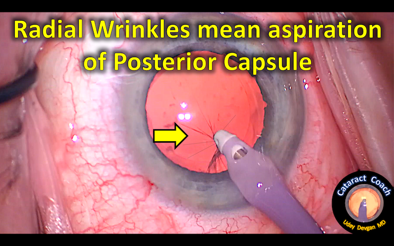 Radial Wrinkles mean aspiration of the capsule! – Cataract Coach