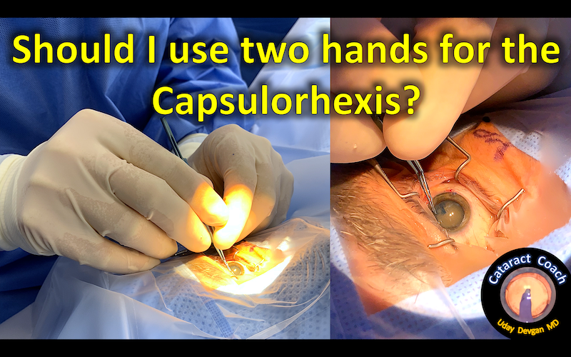 Should you use 2 hands for the capsulorhexis? – Cataract Coach