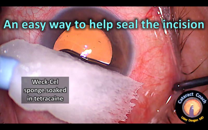 An easy way to help seal the phaco incision – Cataract Coach
