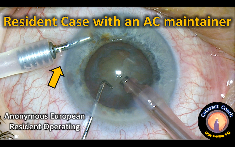 use of an AC maintainer in Cataract Surgery – Cataract Coach™