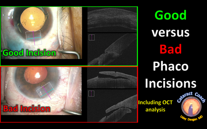 Good versus Bad Corneal Phaco Incisions with OCT – Cataract Coach™