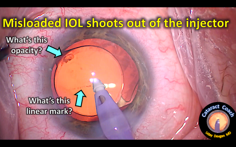 Misloaded IOL shoots out of the injector – Cataract Coach