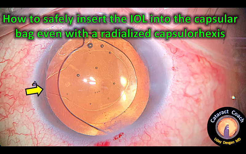 Prevent posterior extension of a capsular break – Cataract Coach