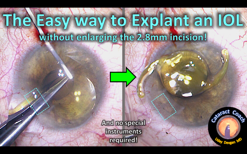 Twist Technique to Easily Explant the IOL – Cataract Coach