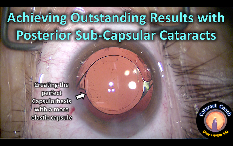 Technique for PSC Cataract Surgery in younger patients – Cataract Coach