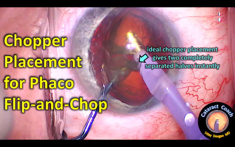 Chopper placement is critical to nucleus division – Cataract Coach™