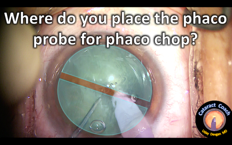 Probe Placement to Facilitate Phaco Chop – Cataract Coach