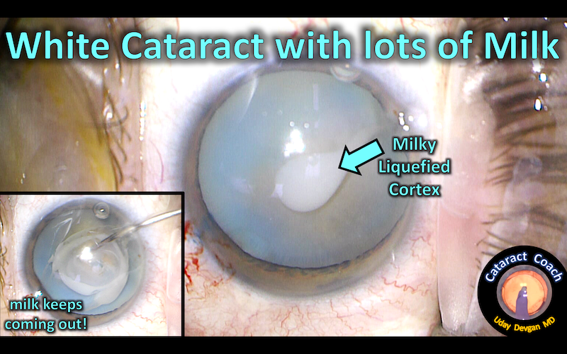 Intumescent White Cataract with lots of Milk – Cataract Coach
