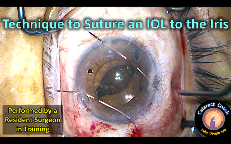 Old IOL explanted, then new IOL sutured to the Iris – Cataract Coach™