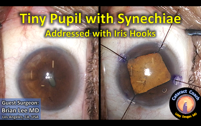 Guest Cataract Surgery: Tiny Pupil with Synechiae – Cataract Coach