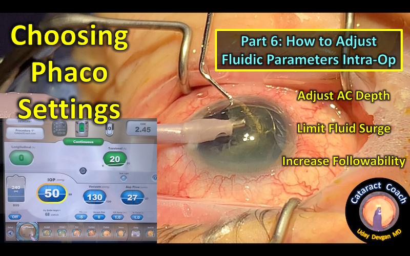Phaco Fundamentals Part 6: Adjusting Fluidic Parameters Intra-Op ...