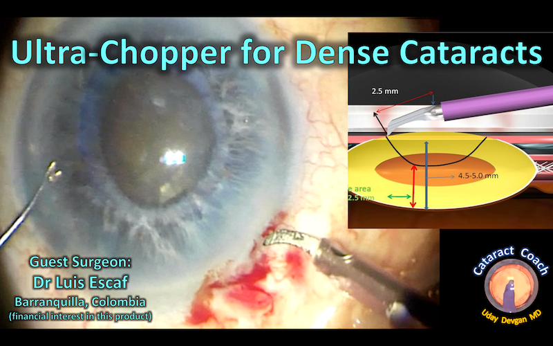 Guest Surgeon: The UltraChopper for Dense Cataracts – Cataract Coach