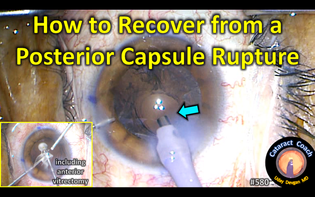 How to recover from a capsule rupture – Cataract Coach