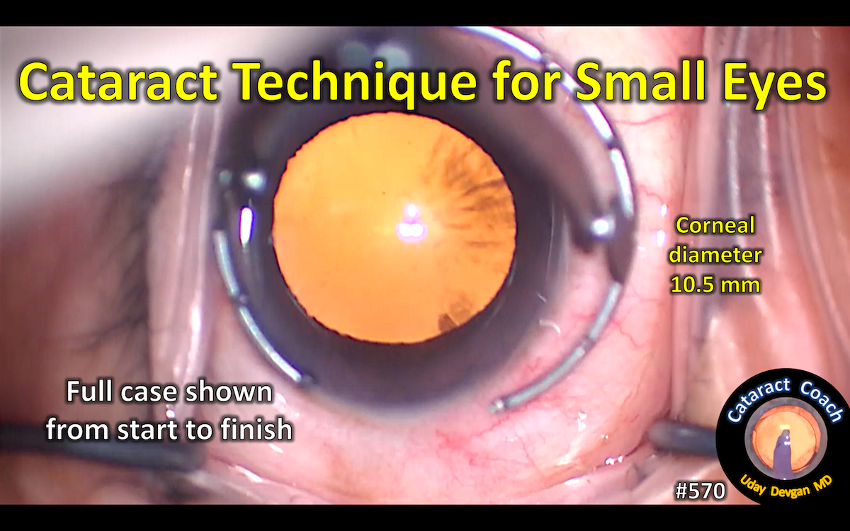 Complete Case: Cataract in a Small Eye – Cataract Coach™