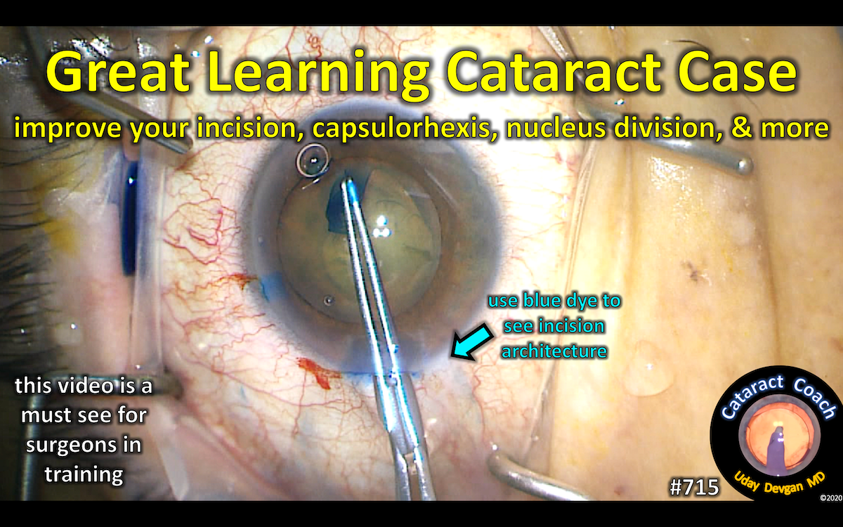 great learning resident cataract case – Cataract Coach