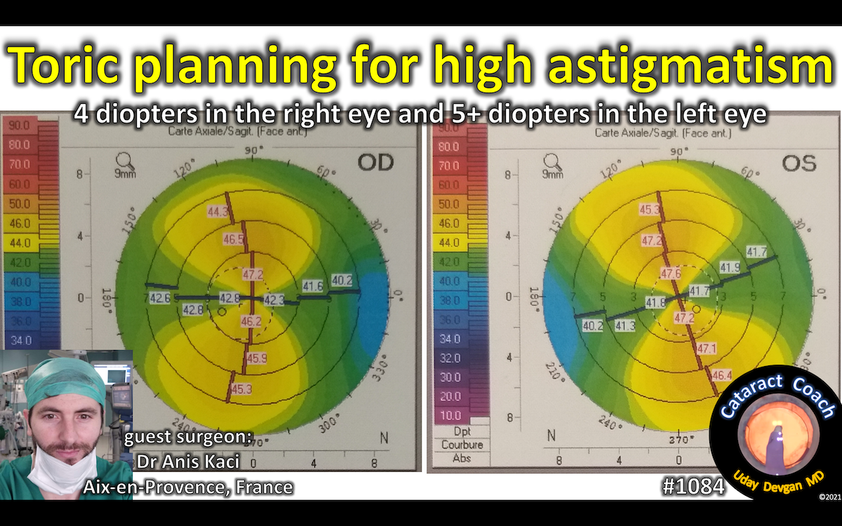 1084: toric planning for high astigmatism – Cataract Coach