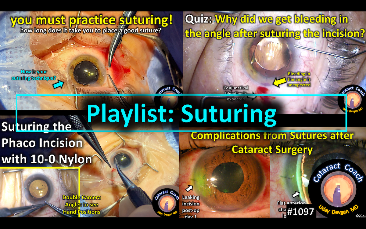 1097: Playlist: Suturing – Cataract Coach