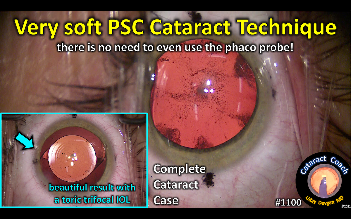 1100: Very soft PSC cataract technique – Cataract Coach