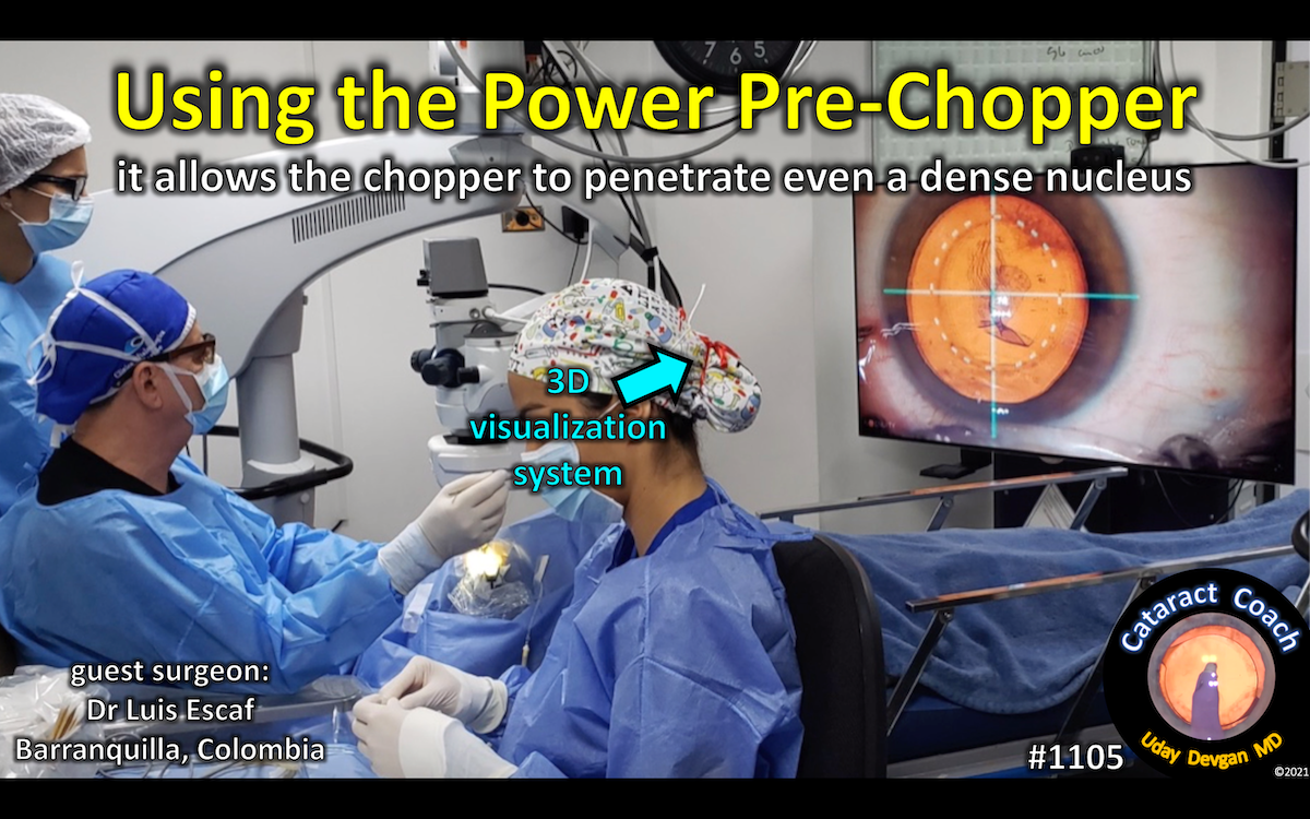 1105: Using the Power Pre-Chopper – Cataract Coach